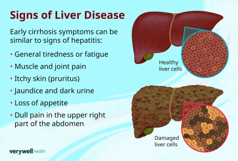 Liver Disease - Vistasol Medical Group